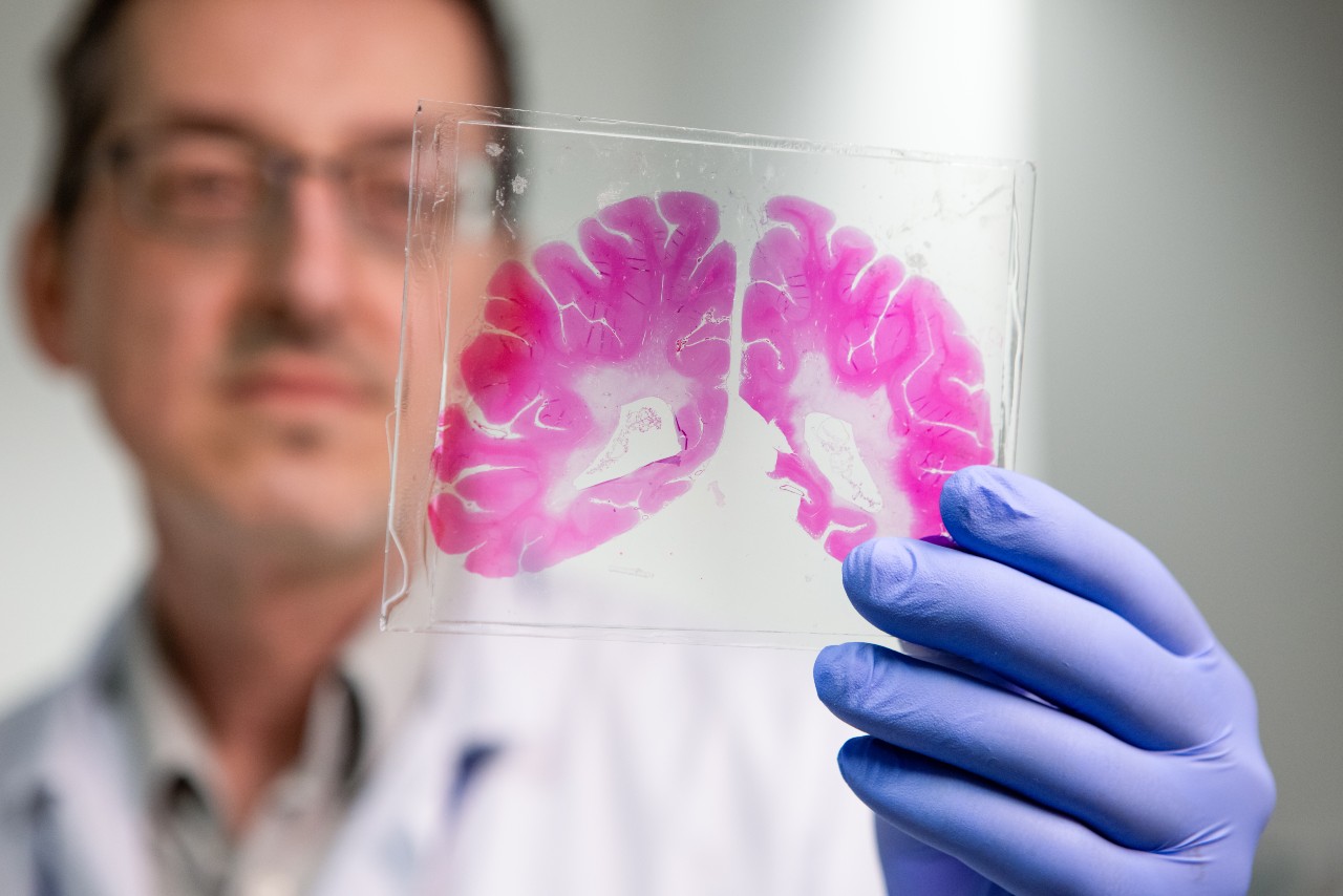 Brain Bank Scan Slide | Parkinson's UK