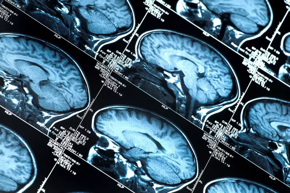 Understanding the effect of cannabidiol (CBD) on brain function ...