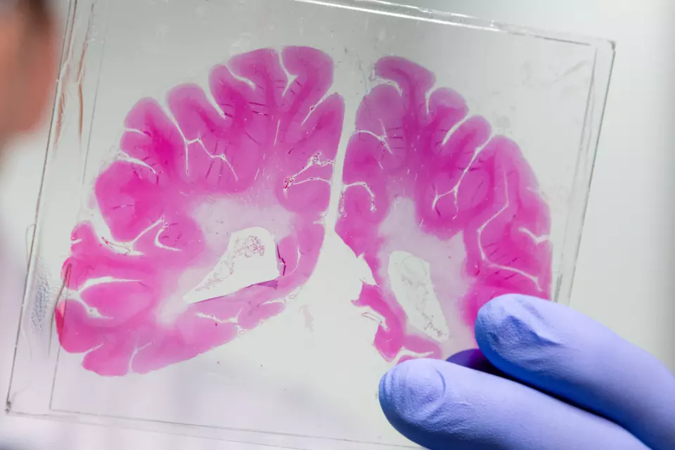 Celebrating the Parkinson’s UK Brain Bank during Brain Awareness Week ...